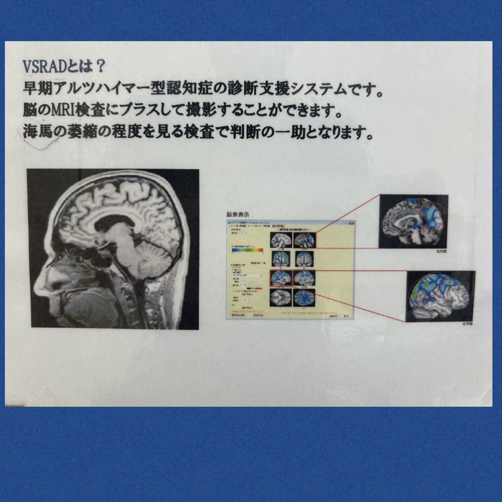 【頭部MRIは、認知症の診断にどこまで迫れるか？~VSRADについて~】 - 四日市消化器病センター